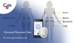 Omnipod 5 Compatible Phones You Need to Know [ updated 2025 ]